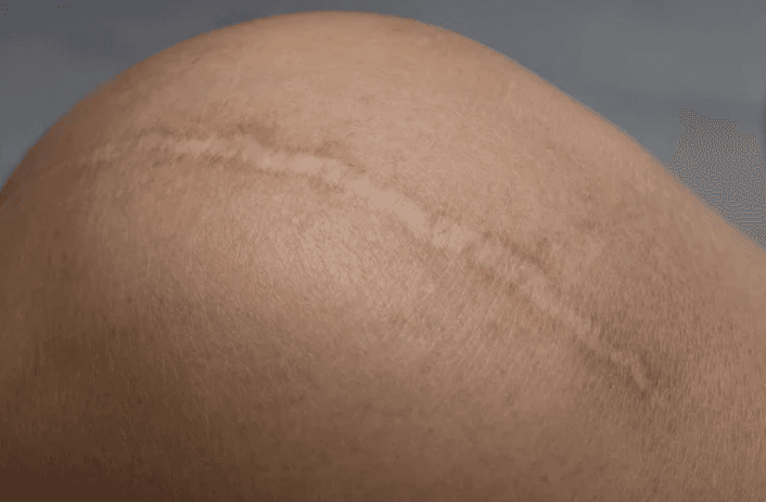 Scars, Marks & Tattoos in Criminal ABIS: A Gamechanger for Law ...